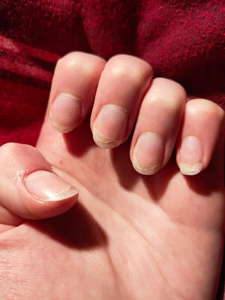 Brittle Nails and Nail Damage: How Recovery RX Can Restore Your Nails ...